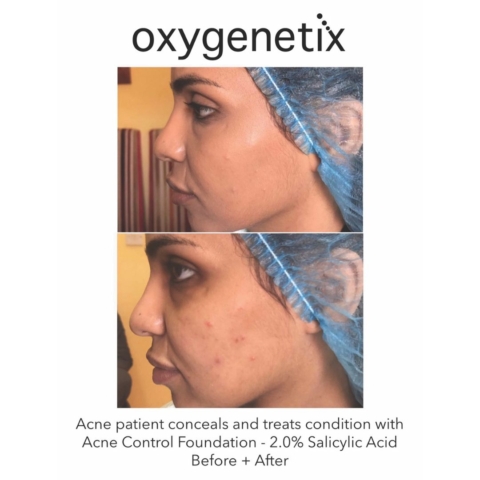 Oxygenetix: Breathable Beauty for Radiant Skin | Dermoi! - UK