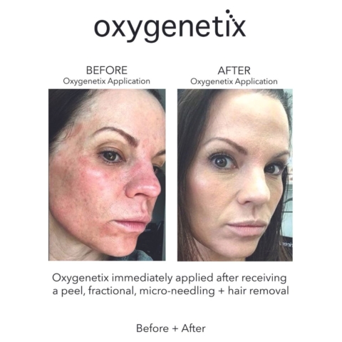 Oxygenetix: Breathable Beauty for Radiant Skin | Dermoi! - UK