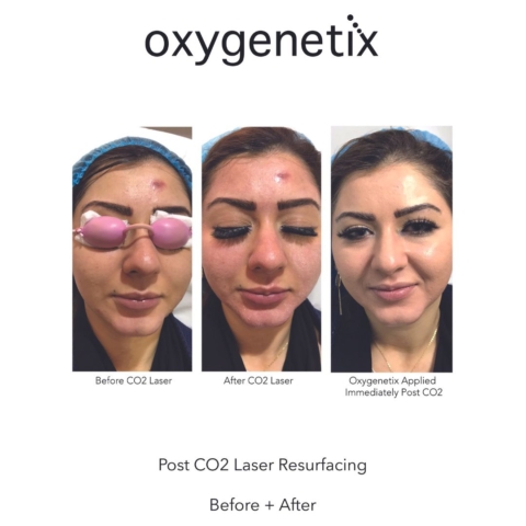 Oxygenetix: Breathable Beauty for Radiant Skin | Dermoi! - UK