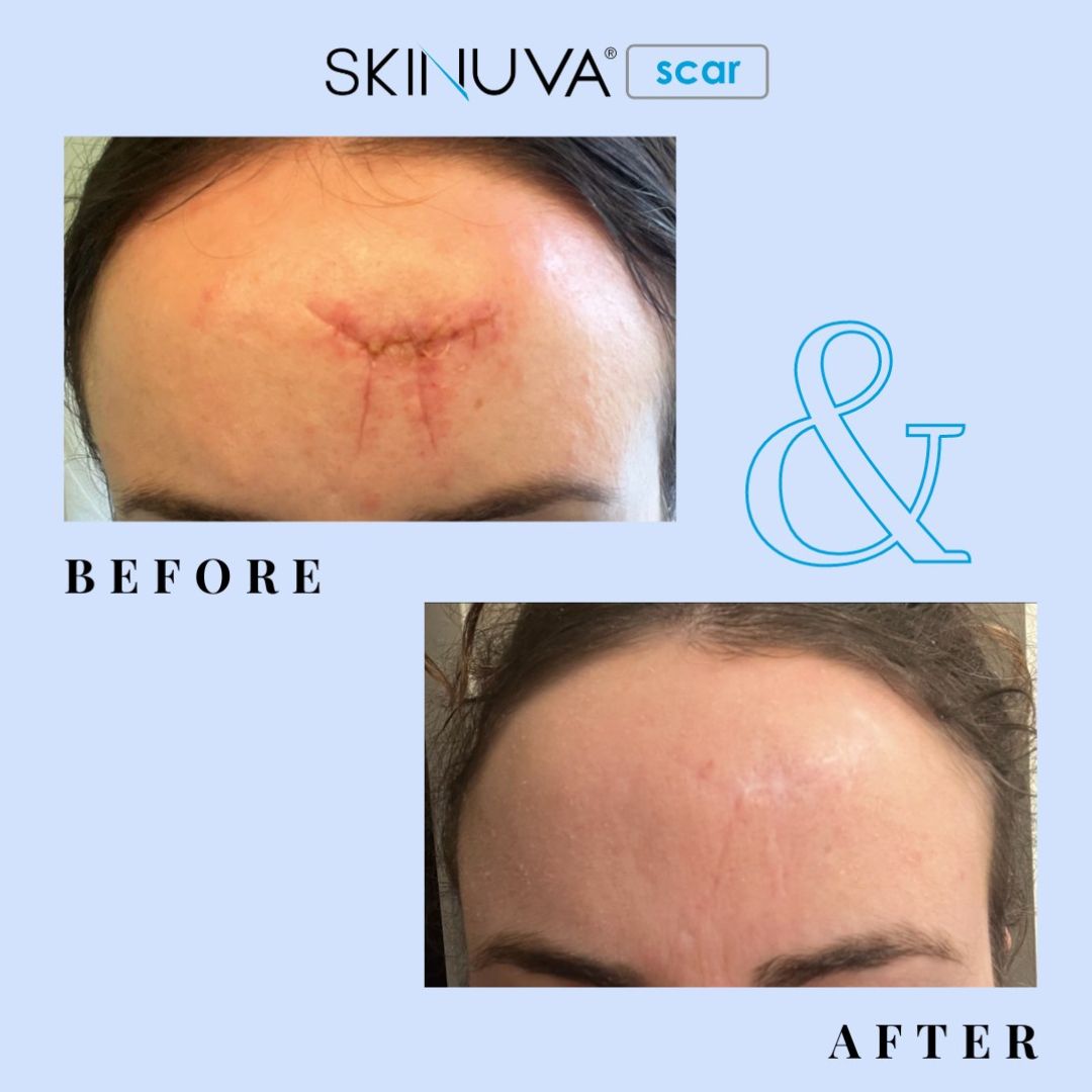 Skinuva Scar Cream - Next Generation Scar Cream - UK - UK