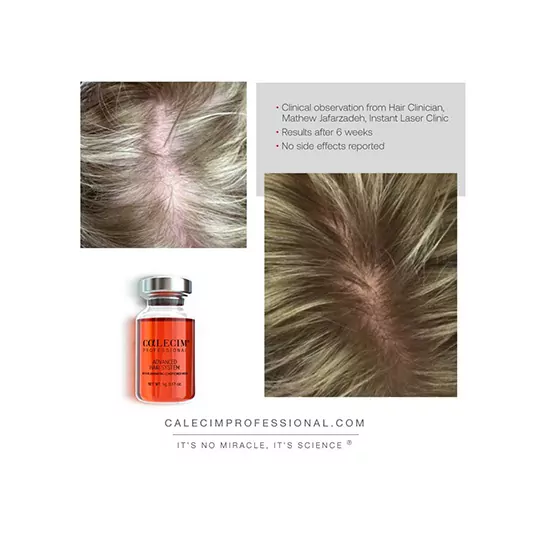 Calecim Professional Advanced Hair System (AHS) - Stem Cells - UK