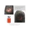 Calecim Professional Advanced Hair System (AHS) - Stem Cells - UK